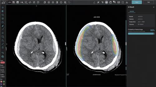 두개내출혈 검출 AI 설루션 'JLK-ICH', 미 FDA 승인 획득 | 연합뉴스